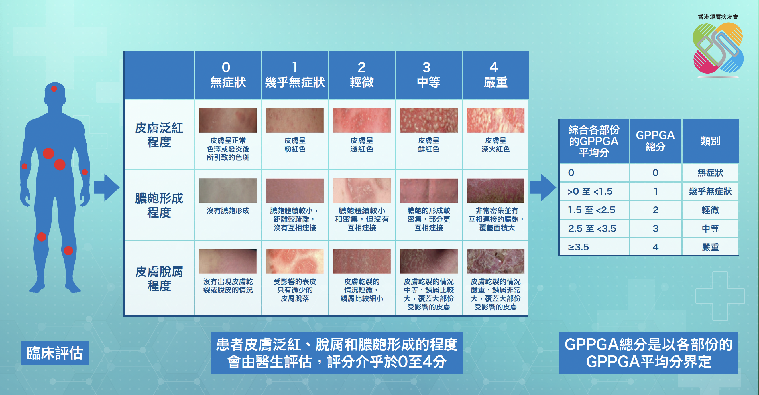 全面剖析泛發性膿皰型銀屑病 了解症狀及診斷方法 - Healthies